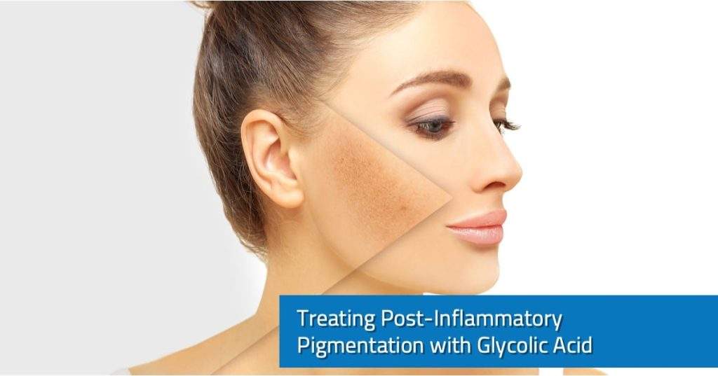 Treating Post-Inflammatory Pigmentation with Glycolic Acid - Coast ...